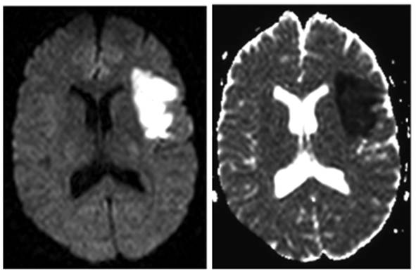 Prise en charge des AVC au SAU - Médecine d'urgence - Urgences médicales